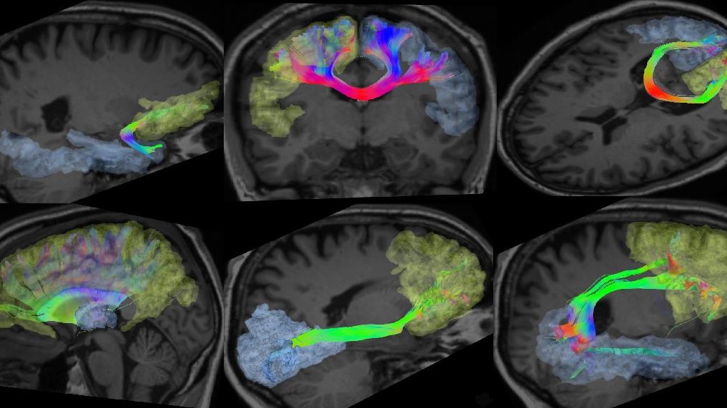 New paper on diffusion MRI by Alia Lemkaddem et al. - EPFL