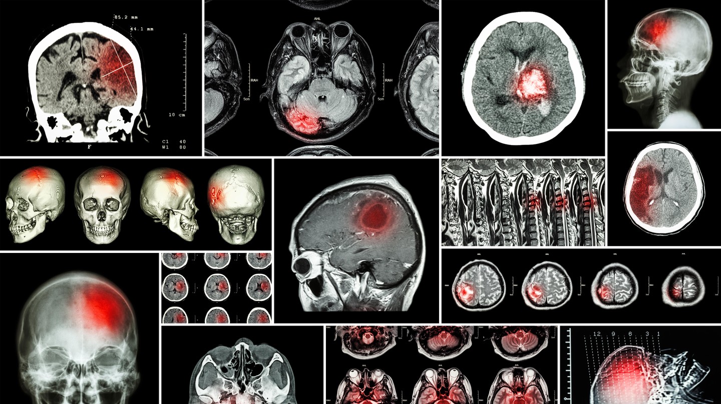 How a waste product of exercise protects neurons from trauma damage - EPFL