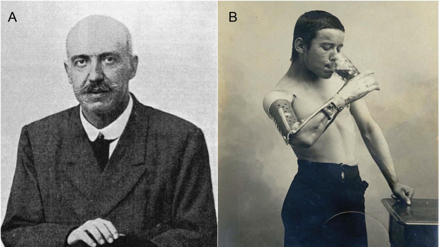 Historical work of Vanghetti inspires today's neuroprosthetics - EPFL